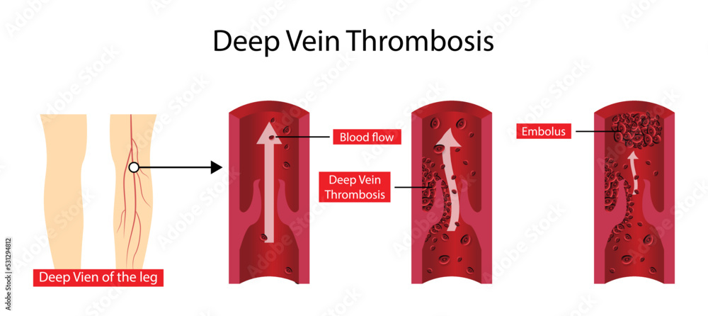 illustration of biology and medical, Deep vein thrombosis can cause leg ...