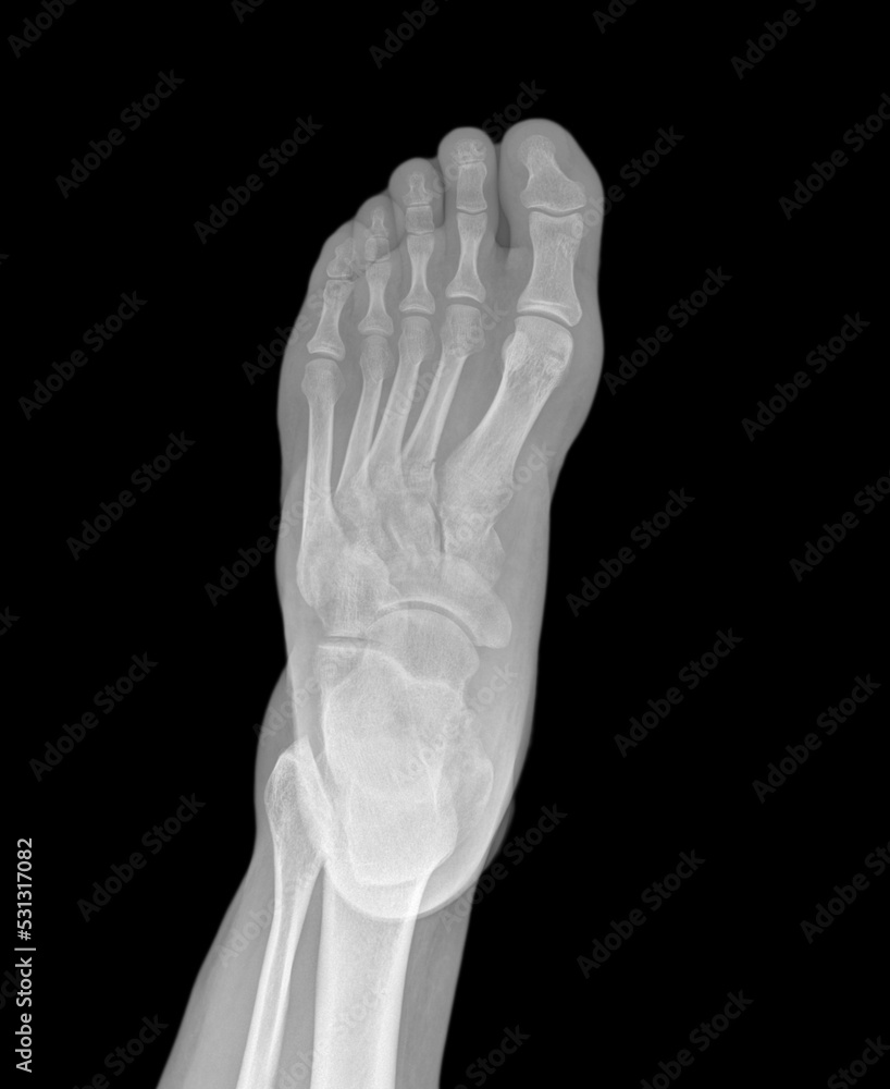 X ray of skeleton of foot. Human foot bones. Anatomy of joints. Foot ...