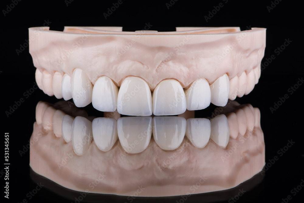 Quality dental prosthesis made of titanium beam and ceramics for ...