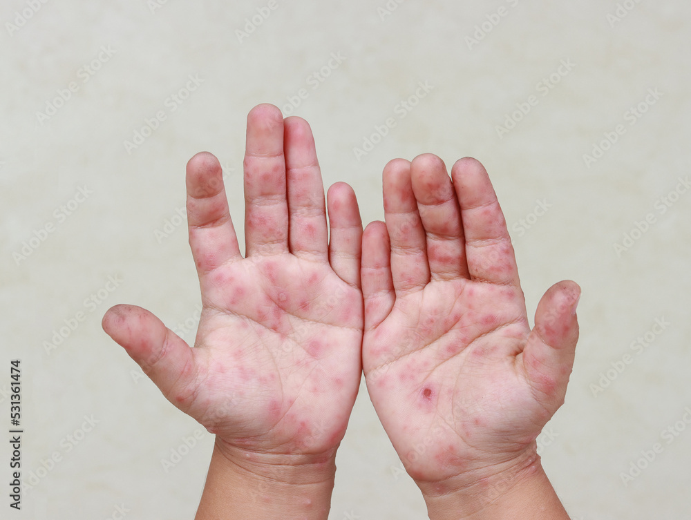 HFMD Rash and red blisters on the body of a child foto de Stock | Adobe ...