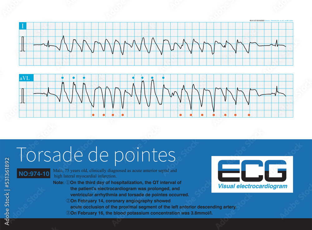 During an episode of torsade de pointes, the polarity of the QRS ...