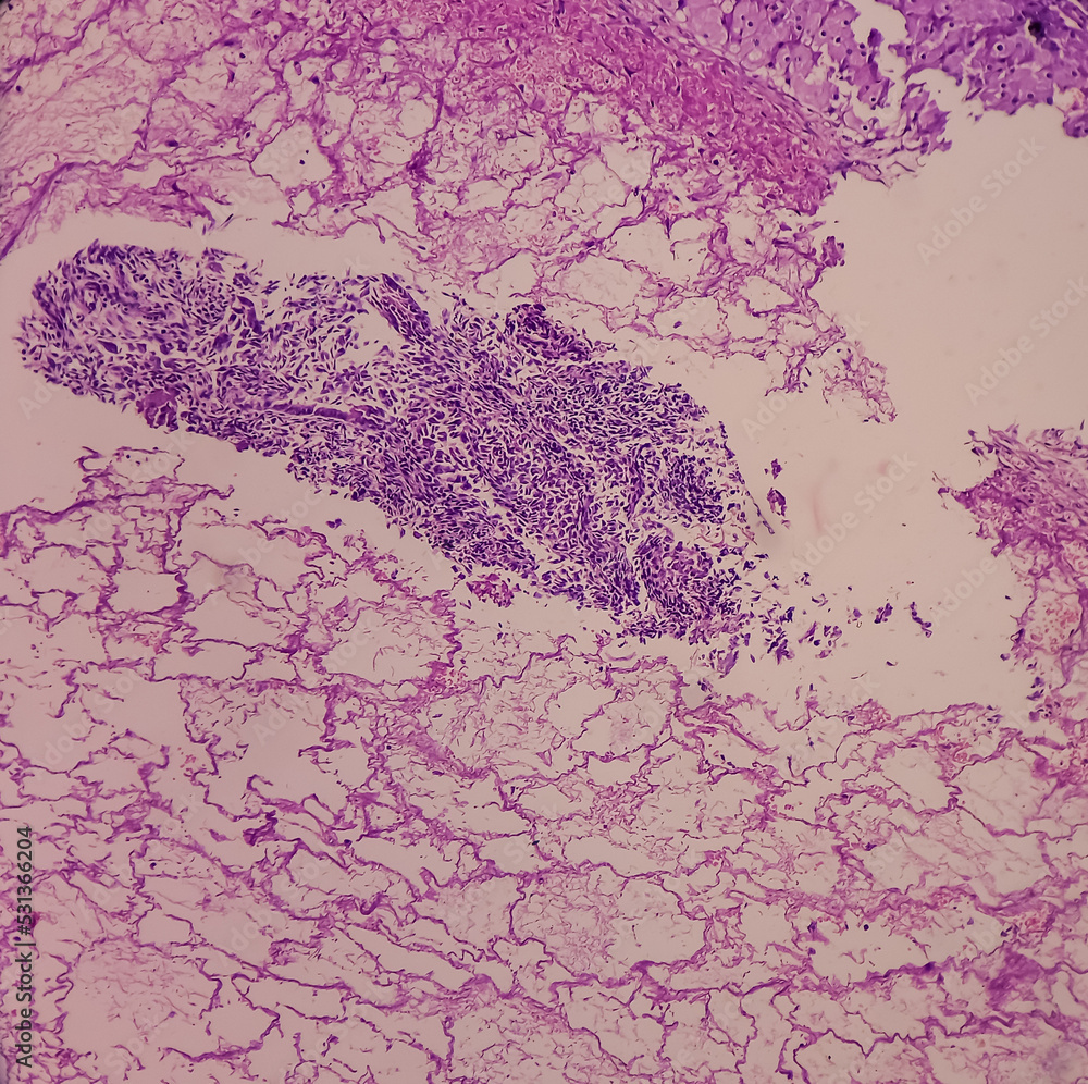 Uterus biopsy: Chronic cervicitis, proliferative phase, leiomyoma ...