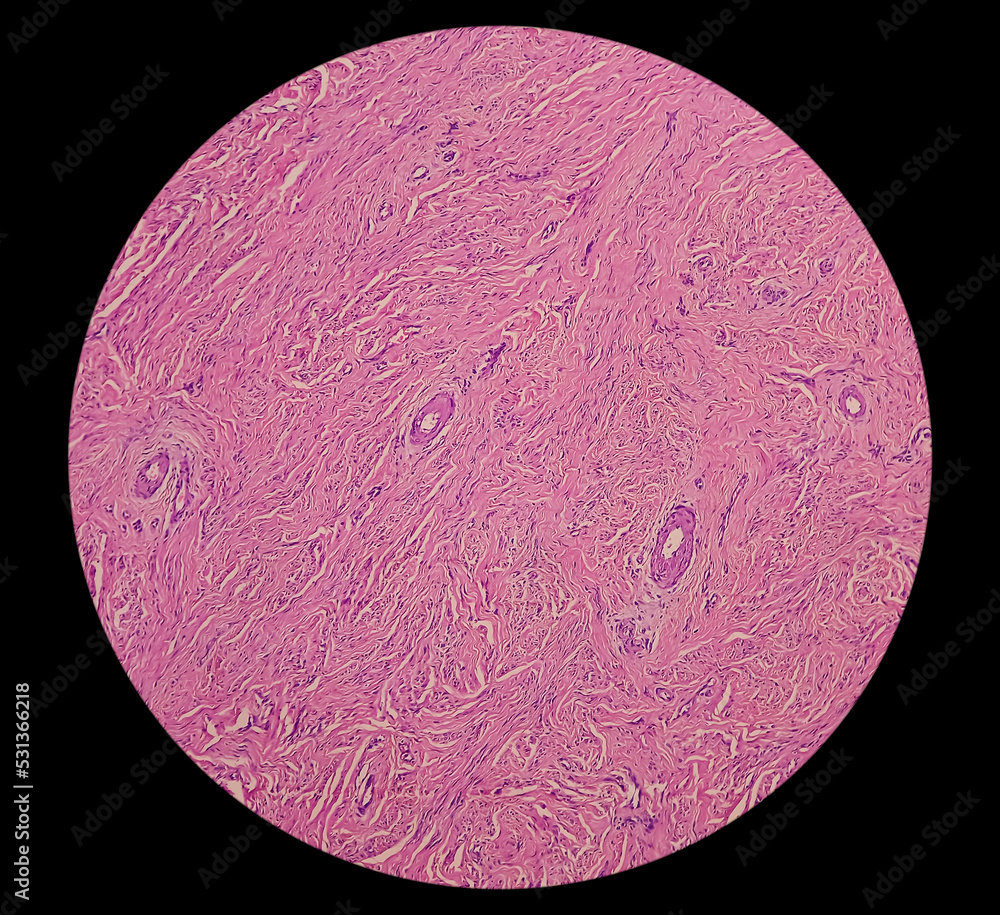 Uterus biopsy: Chronic cervicitis with squamous metaplasia ...