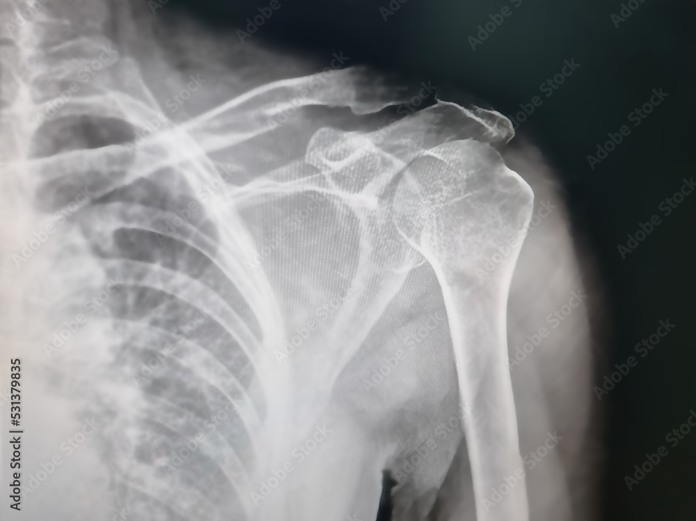 arm bone x-ray images blur and noise Stock Photo | Adobe Stock