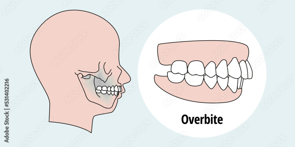 Side view of man after orthodontic treatment, right teeth aligned Stock ...