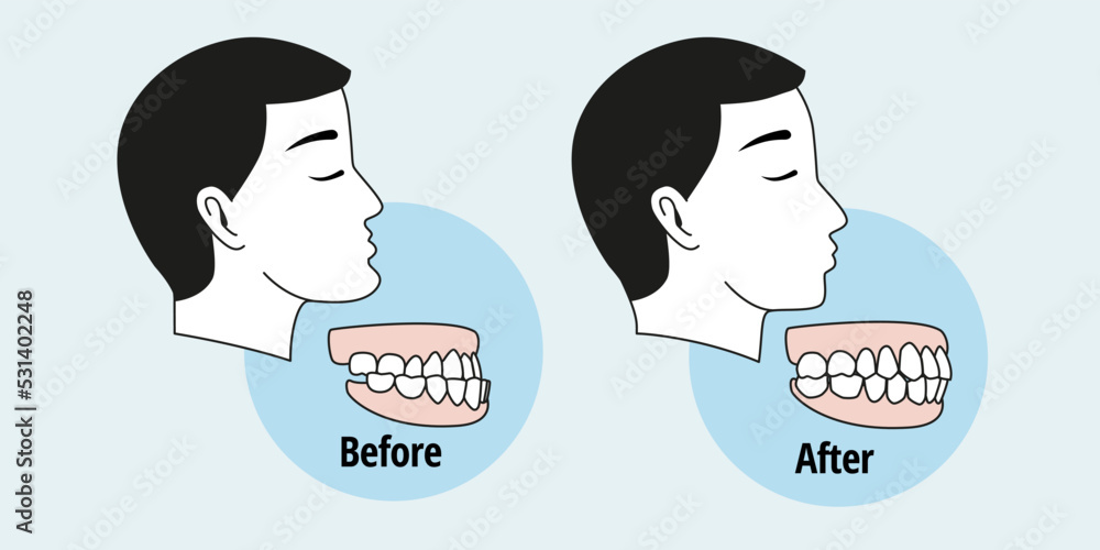 Before and after dental problem. Side view of man with misaligned teeth ...
