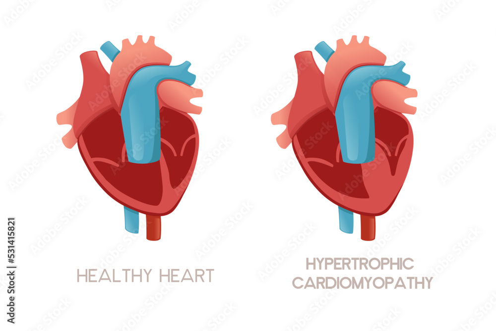 Healthy human heart and heart with hypertrophic cardiomyopathy disease ...