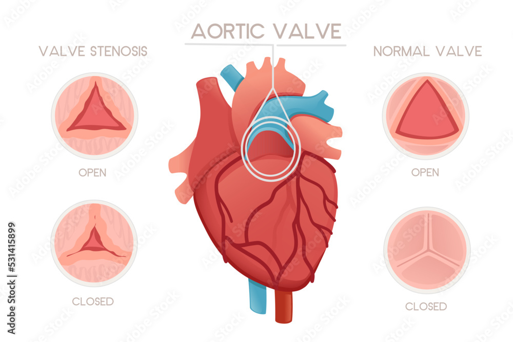 Healthy human heart with valves and valve stenosis disease anatomy ...