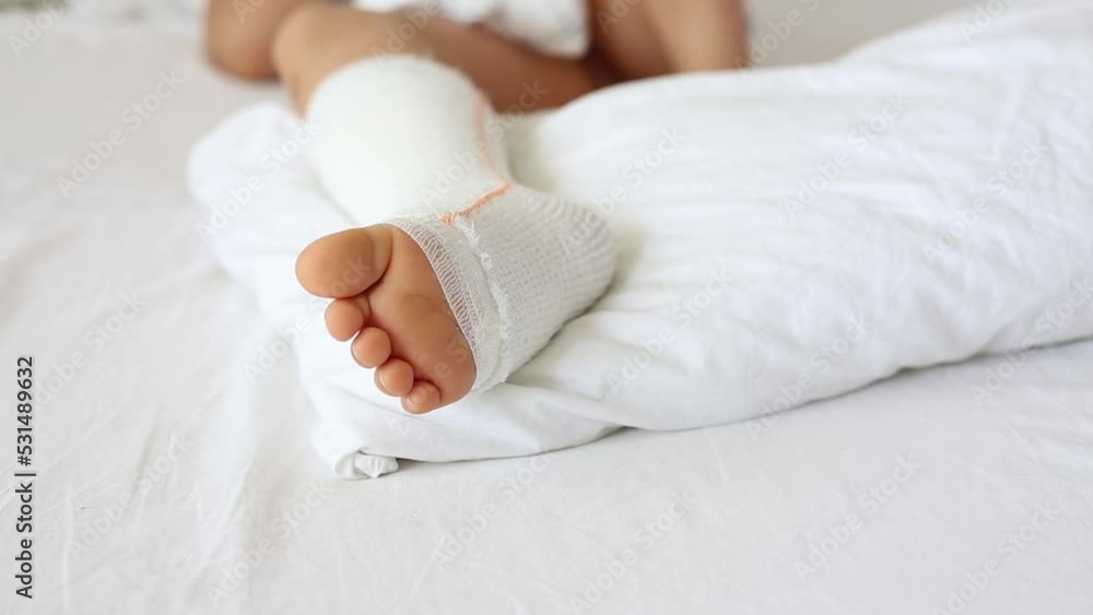 Children's leg in orthopedic cast on a white bed in the orthopedic ...