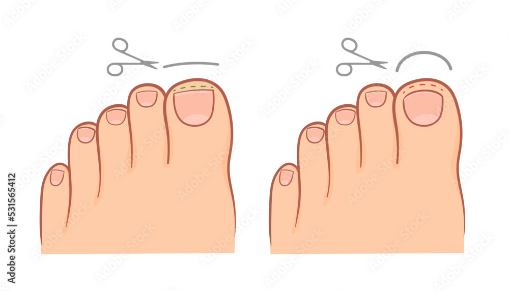 correct and improper cutting of the toenail. medical illustration Stock ...