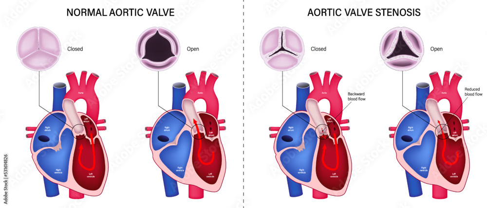 Normal Aortic Valve