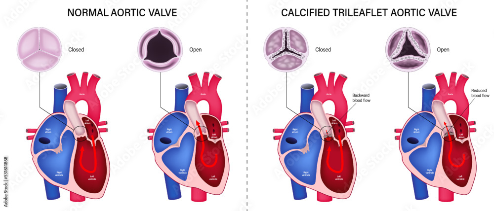 Plakat The difference of normal aortic valve and calcified trileaflet ...