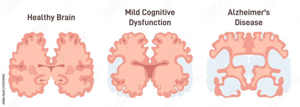 Human brain MRI scan. Healthy and Alzheimer's disease brain Stock Vector | Adobe Stock