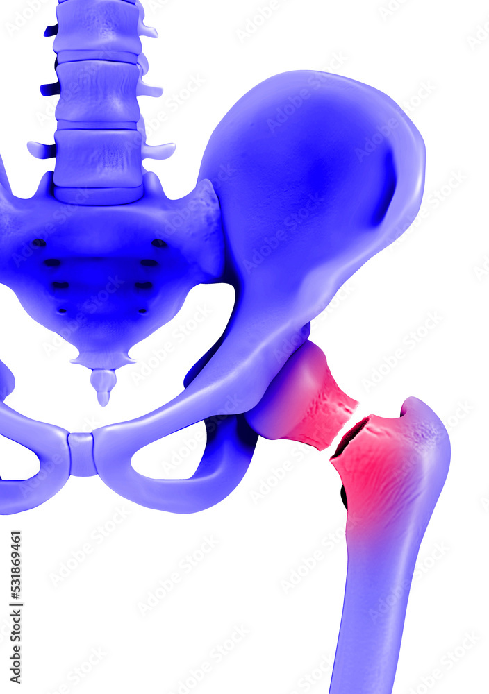 Femure fracture, illustration Stock Illustration | Adobe Stock