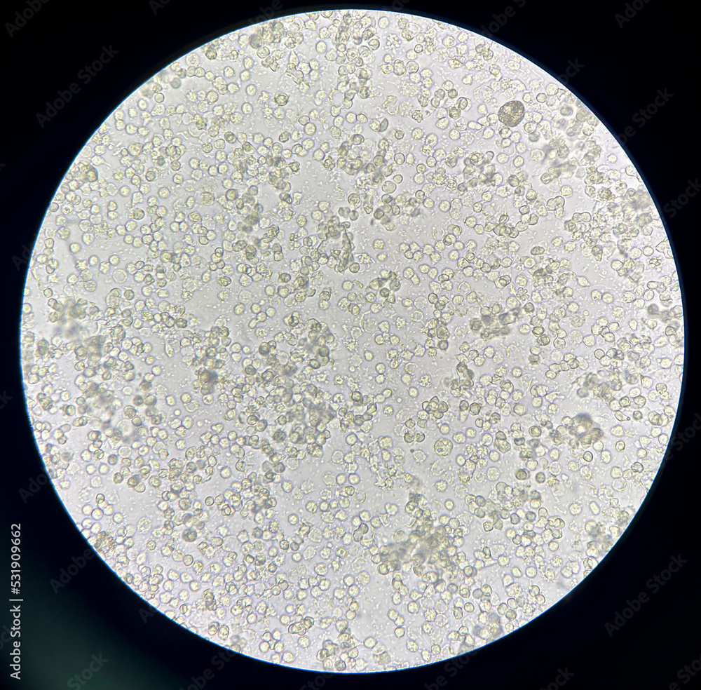 Moderate bacteria and white blood cells in urine. Stock Photo | Adobe Stock
