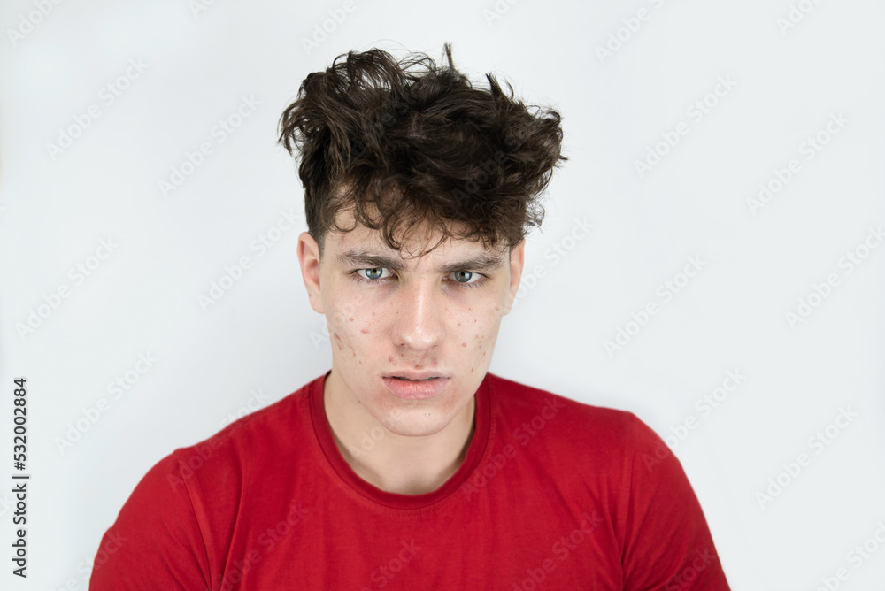 Handsome teenage boy with dark tousled hair and pimples on his face ...