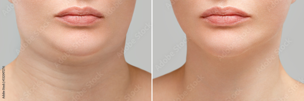 Female double chin before and after correction. Correction of the chin ...