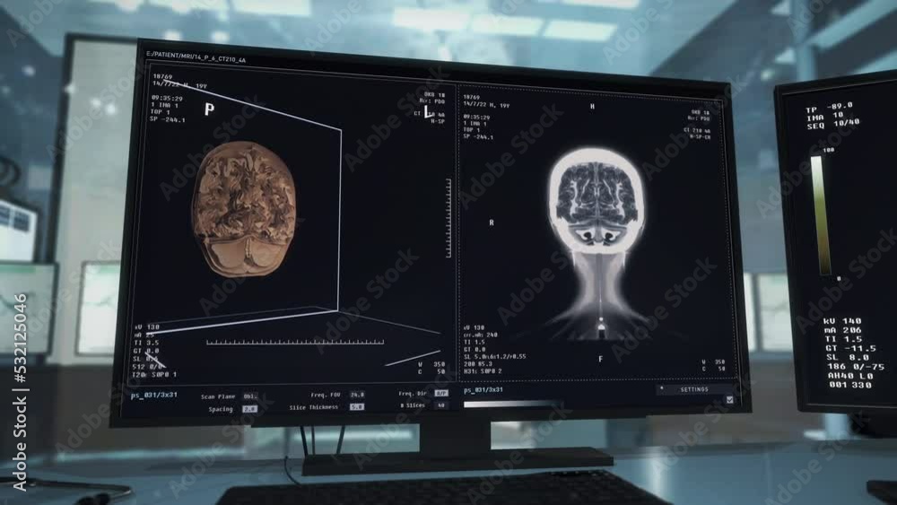 Video Stock Hospital scanner examines the skull injuries of the ...