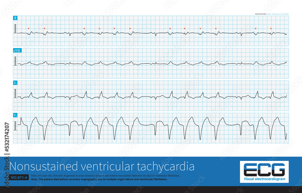 This case is a patient with acute extensive anterior myocardial ...