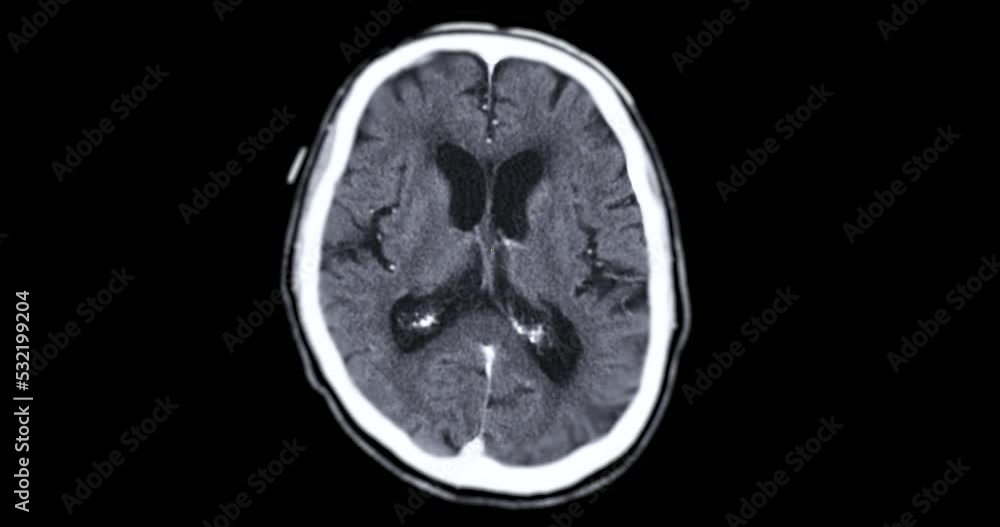 CT scan of the brain for diagnosis brain tumor,stroke diseases and ...