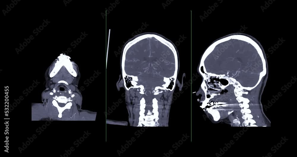 CTA Brain or Computed tomographic angiography of cerebral artery 2D ...