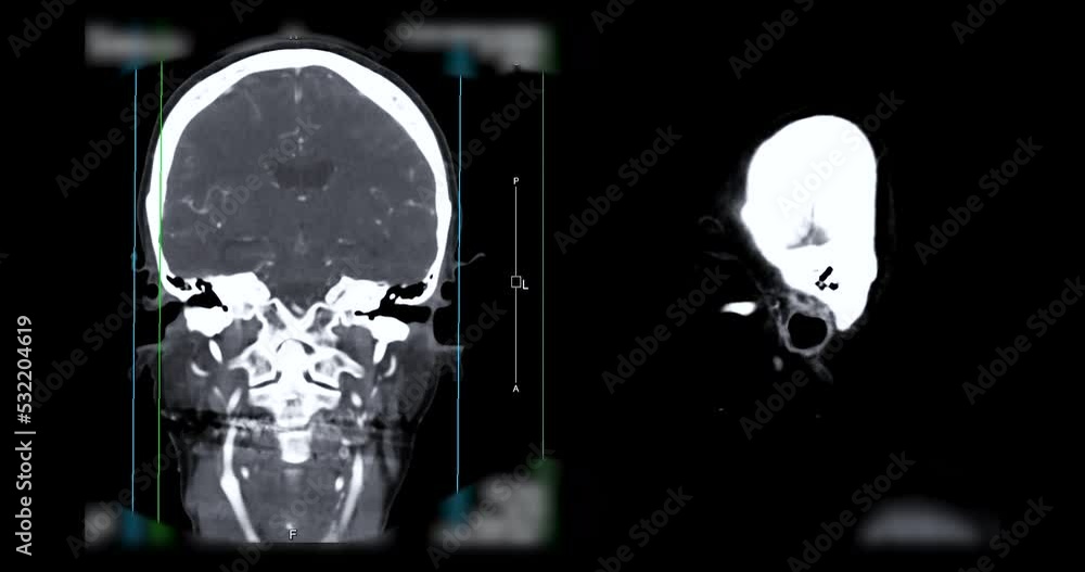 CTA Brain or Computed tomographic angiography of cerebral artery 2D ...