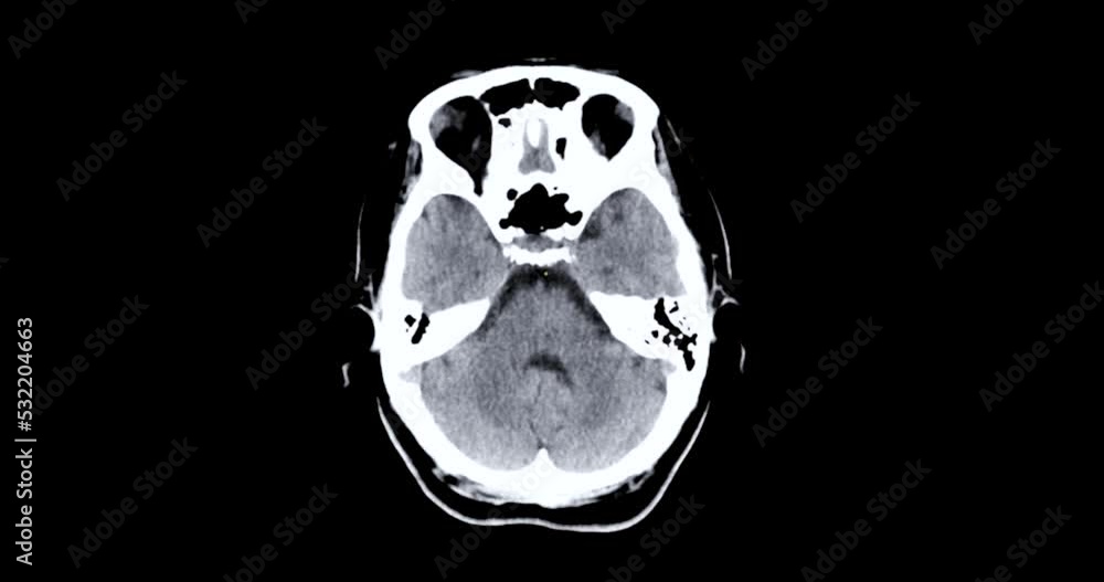 CT scan of the brain for diagnosis brain tumor,stroke diseases and ...