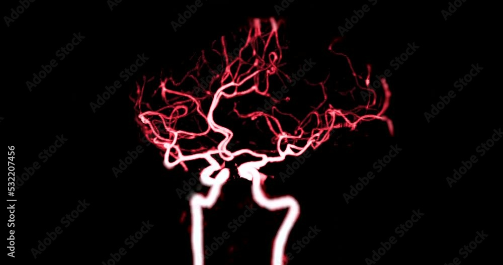 CTA Brain or Computed tomographic angiography of cerebral artery 2D ...