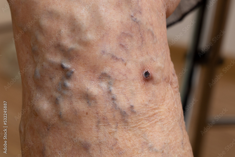 Cropped bare leg with ulcer, varicose veins. Edema skin dermatology and ...