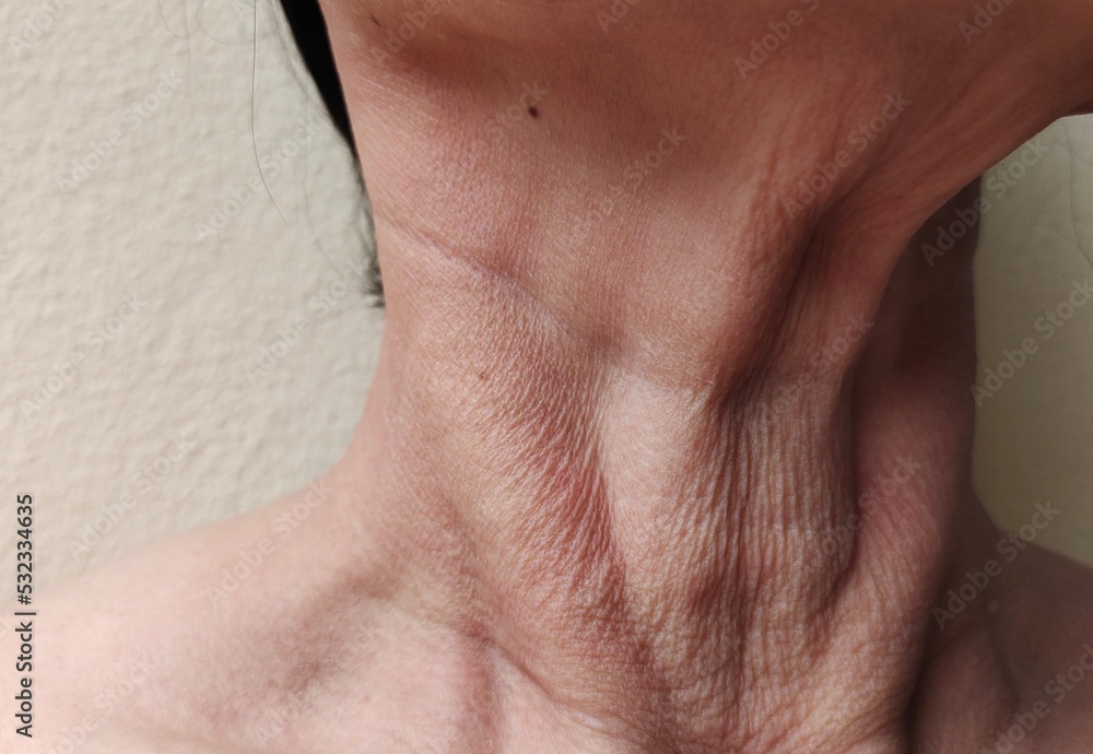 Portrait showing the flabbiness and wrinkle under the neck, rough skin ...