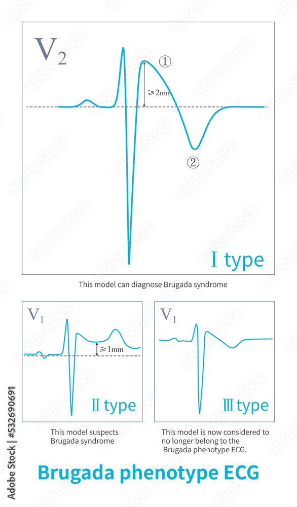 Only type 1 Brugada phenotype ECGs can directly diagnose Brugada ...
