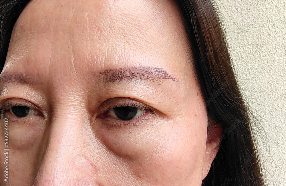 Portrait showing the flabbiness adipose sagging skin under the eyes ...