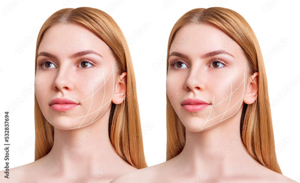 Woman before and after cheekbones shape correction. Stock Photo | Adobe ...
