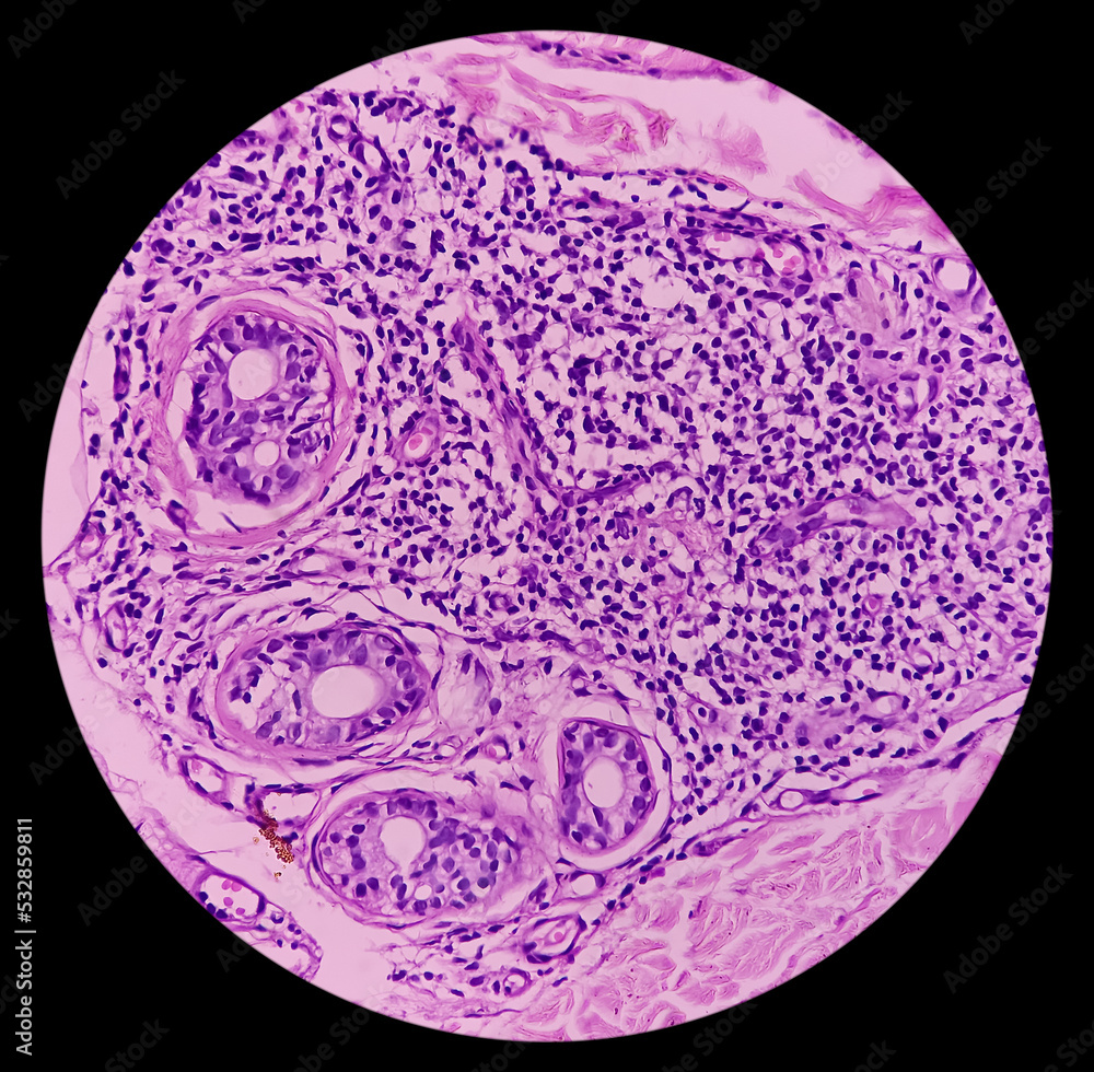 Skin tissue biopsy: Lichen planus. show skin tissue, hyperplastic ...