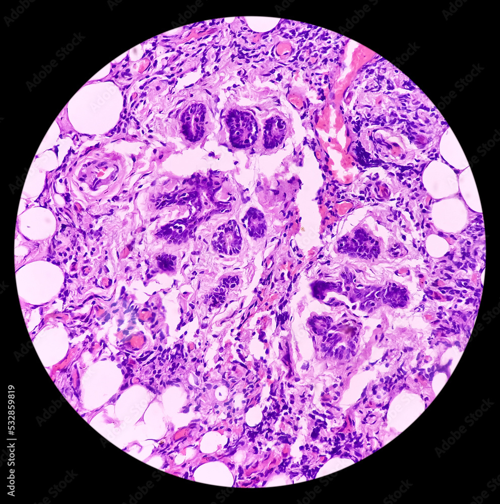 Microphotograph of parotid gland, Chronic parotitis, show parotid ...