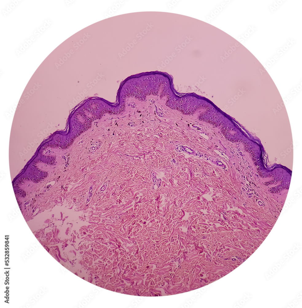 Skin tissue biopsy: Lichen planus. show skin tissue, hyperplastic ...