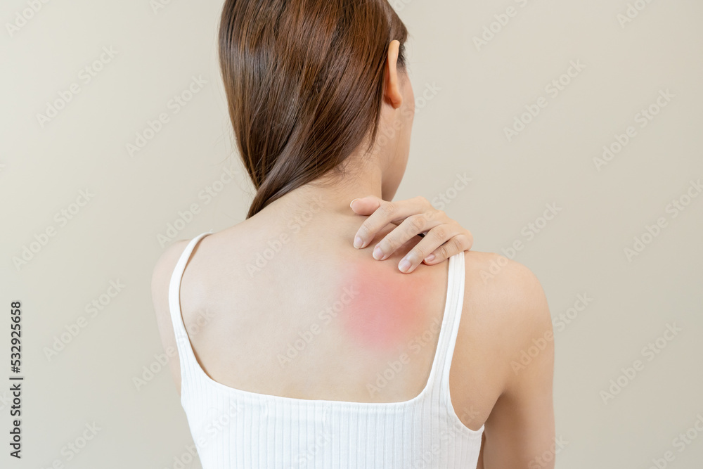 Dermatology, asian young woman, girl allergy, allergic reaction from ...