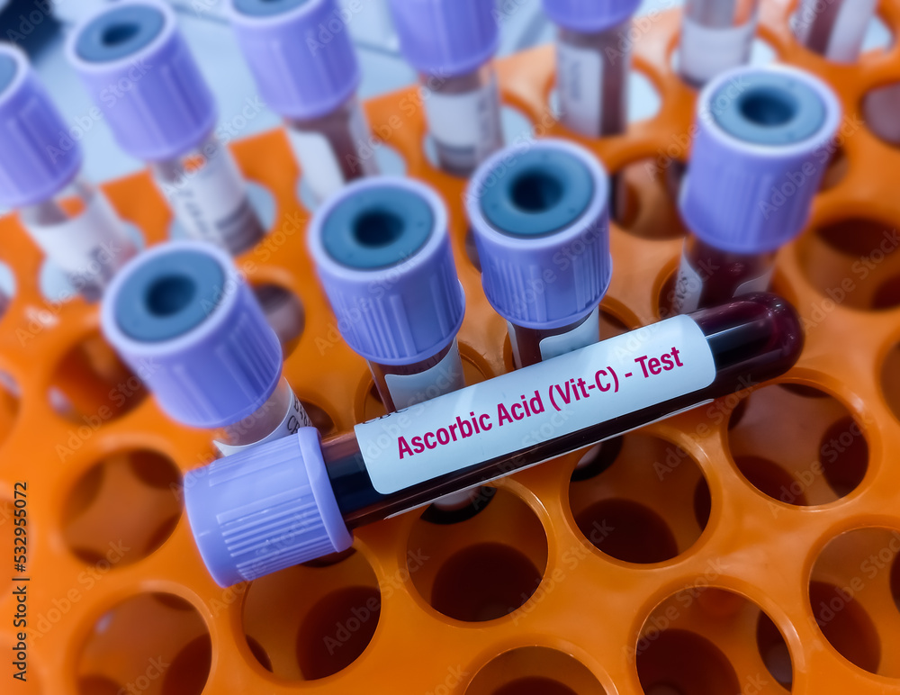 Blood sample for ascorbic acid(vit-C) test to diagnosis vitamin C ...
