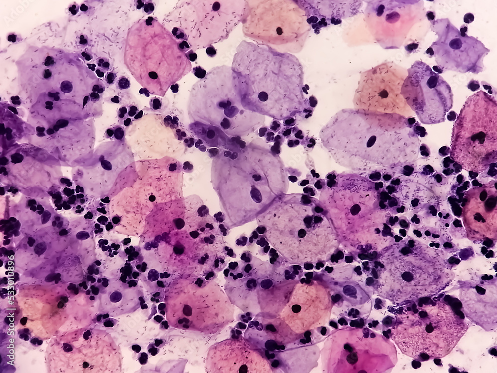 Microscopic view of PAP'S smear showing severe negative for ...
