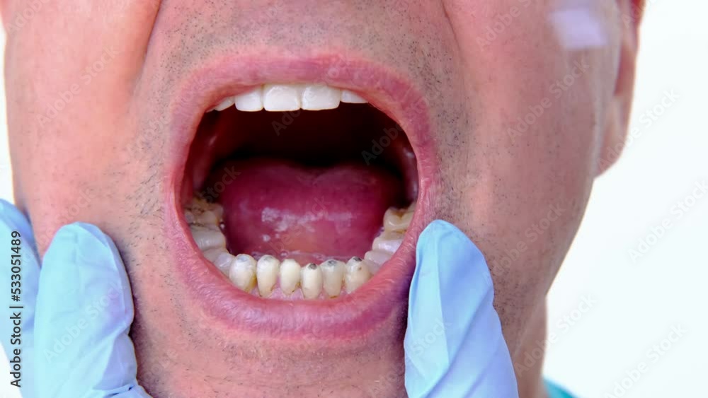 close-up of mature man, senior 60 years in dental office, open mouth ...