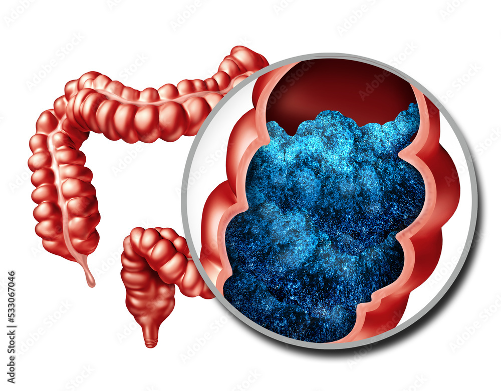 Intestine Bloating And constipation anatomy or constipated symptoms as ...