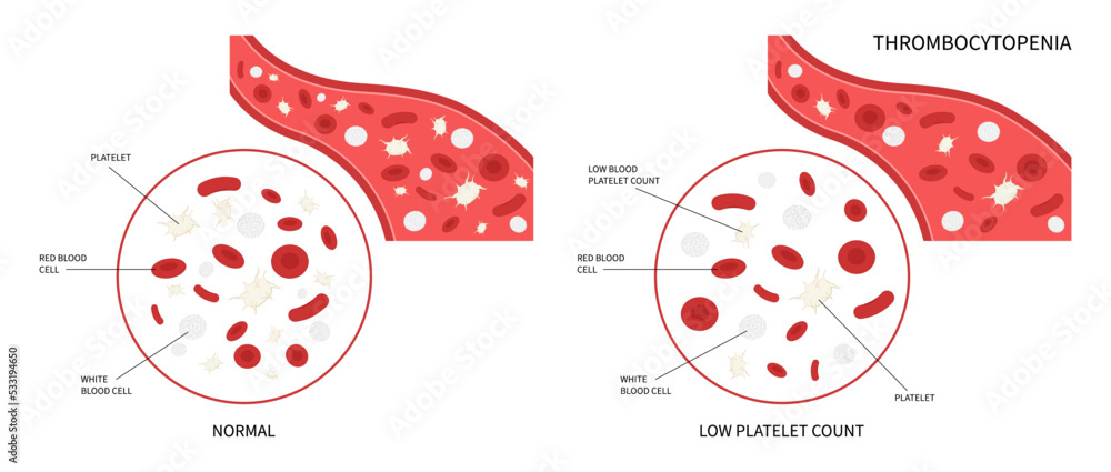 Decreased platelet count of enlarged spleen disorder complete low ...