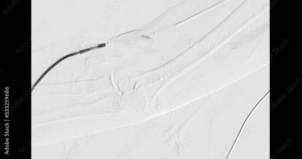 Angiogram balloon dialysis catheter inflated at Arteriovenous (AV ...