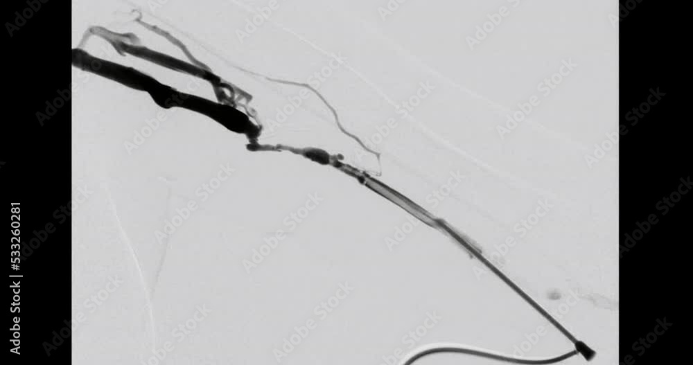 Angiogram balloon dialysis catheter inflated at Arteriovenous (AV ...