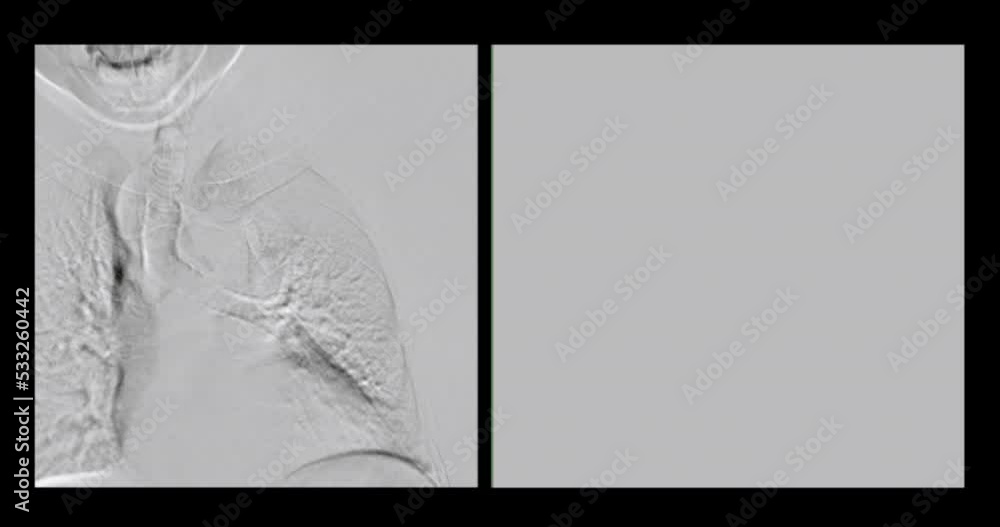 Angiogram balloon dialysis catheter inflated at Arteriovenous (AV ...