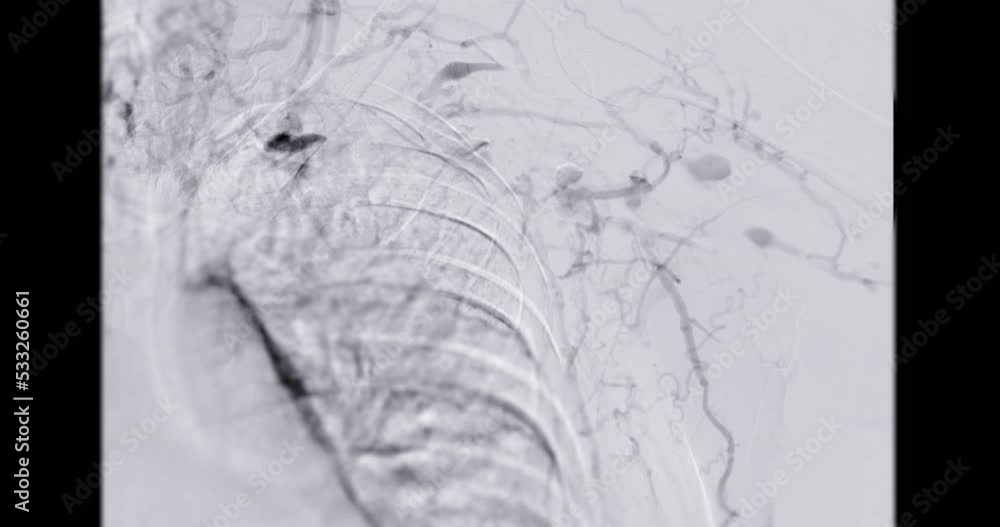 Angiogram balloon dialysis catheter inflated at Arteriovenous (AV ...