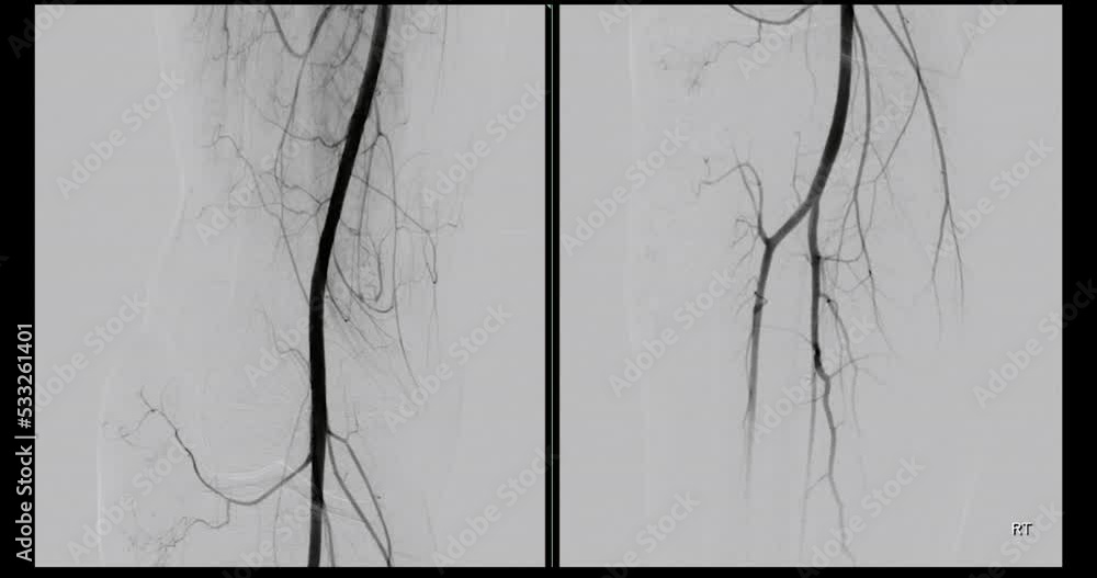 Femoral Angiogram of femoral artery showing femoral artery vessel ...