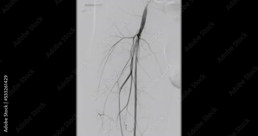 Femoral Angiogram of femoral artery showing femoral artery vessel ...