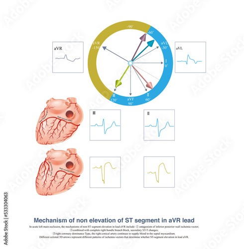 Plakat When acute left main trunk occlusion occurs, the ST segment of ...