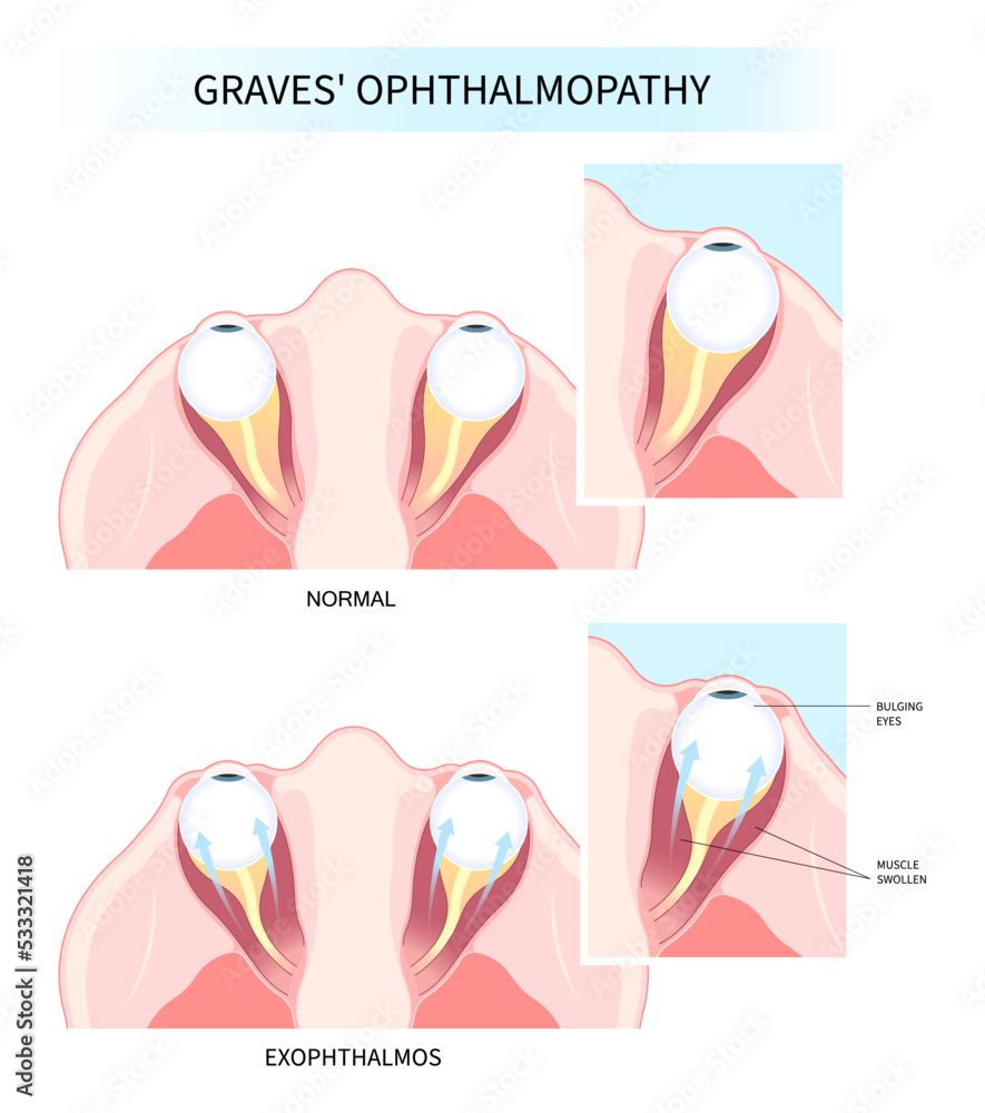 enlargement of the eye with Hashimoto's thyroiditis and Graves' disease ...